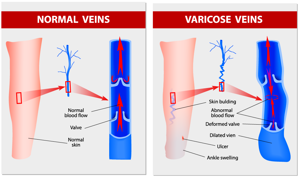 Berhati- hati Apabila Mengurut Bahagian ‘Varicose Vein’ - My Rehab Spa